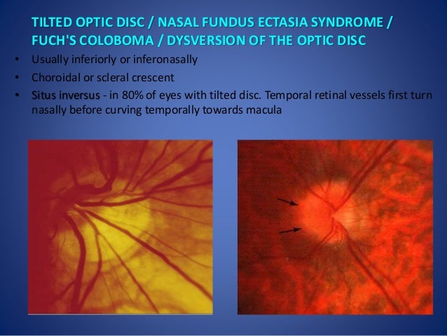 Optic disc evaluation