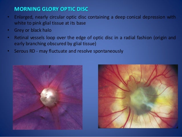 Optic Disc Evaluation
