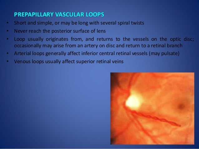 Optic disc evaluation