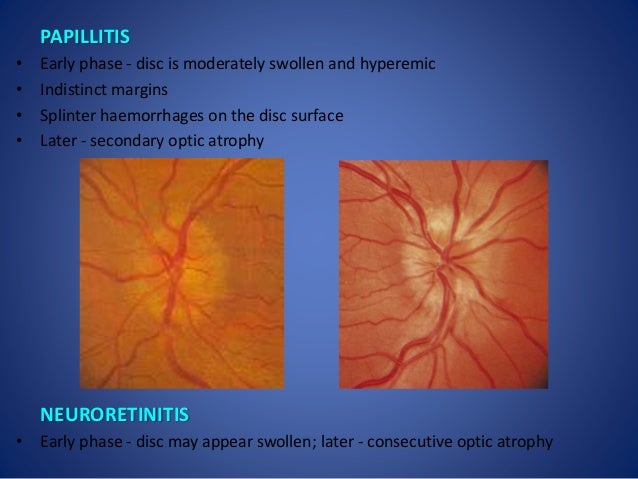 Optic disc evaluation