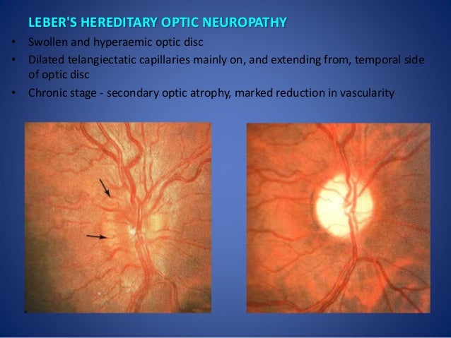 Optic disc evaluation