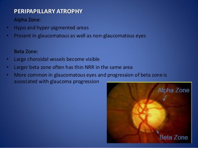 Optic disc evaluation