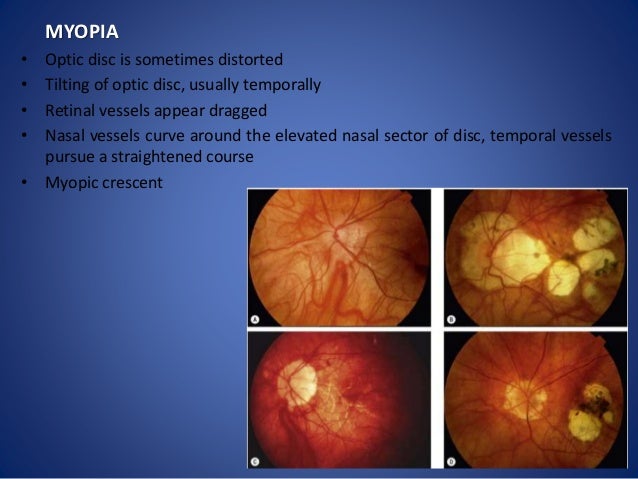 Tilted Optic Disc