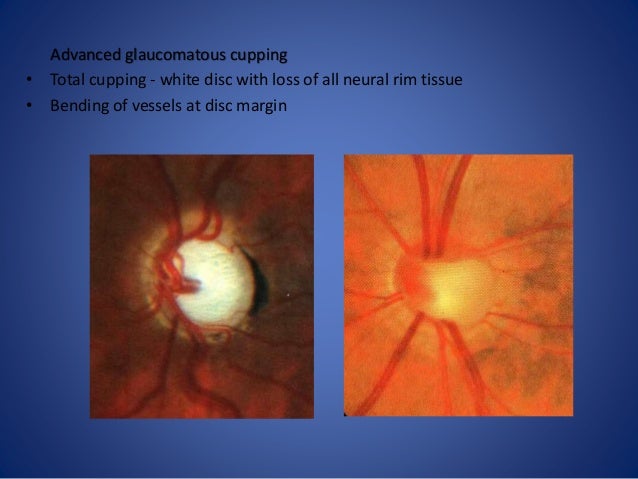 Optic disc evaluation