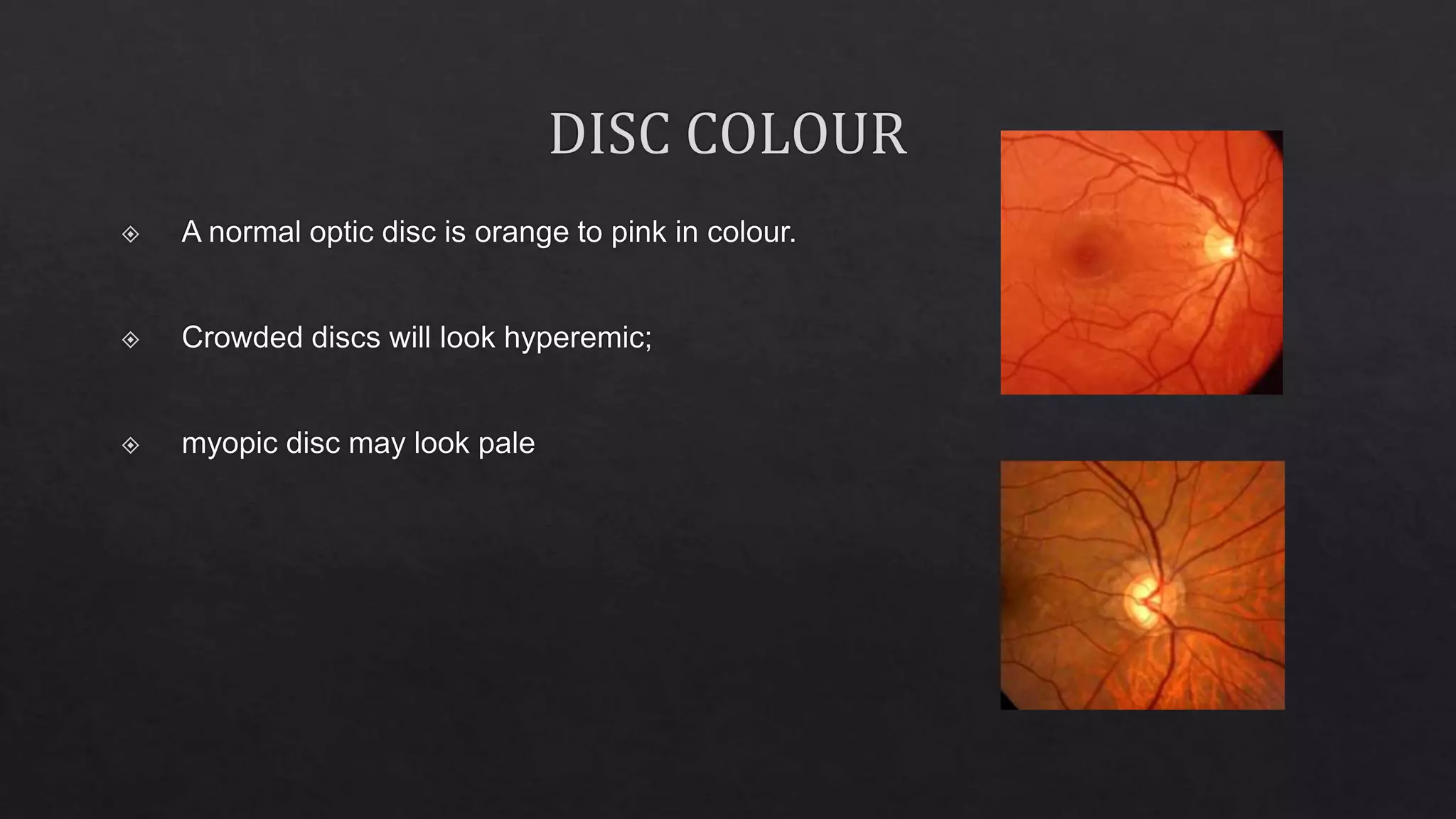 optic disc evaluation in glaucoma.pptx