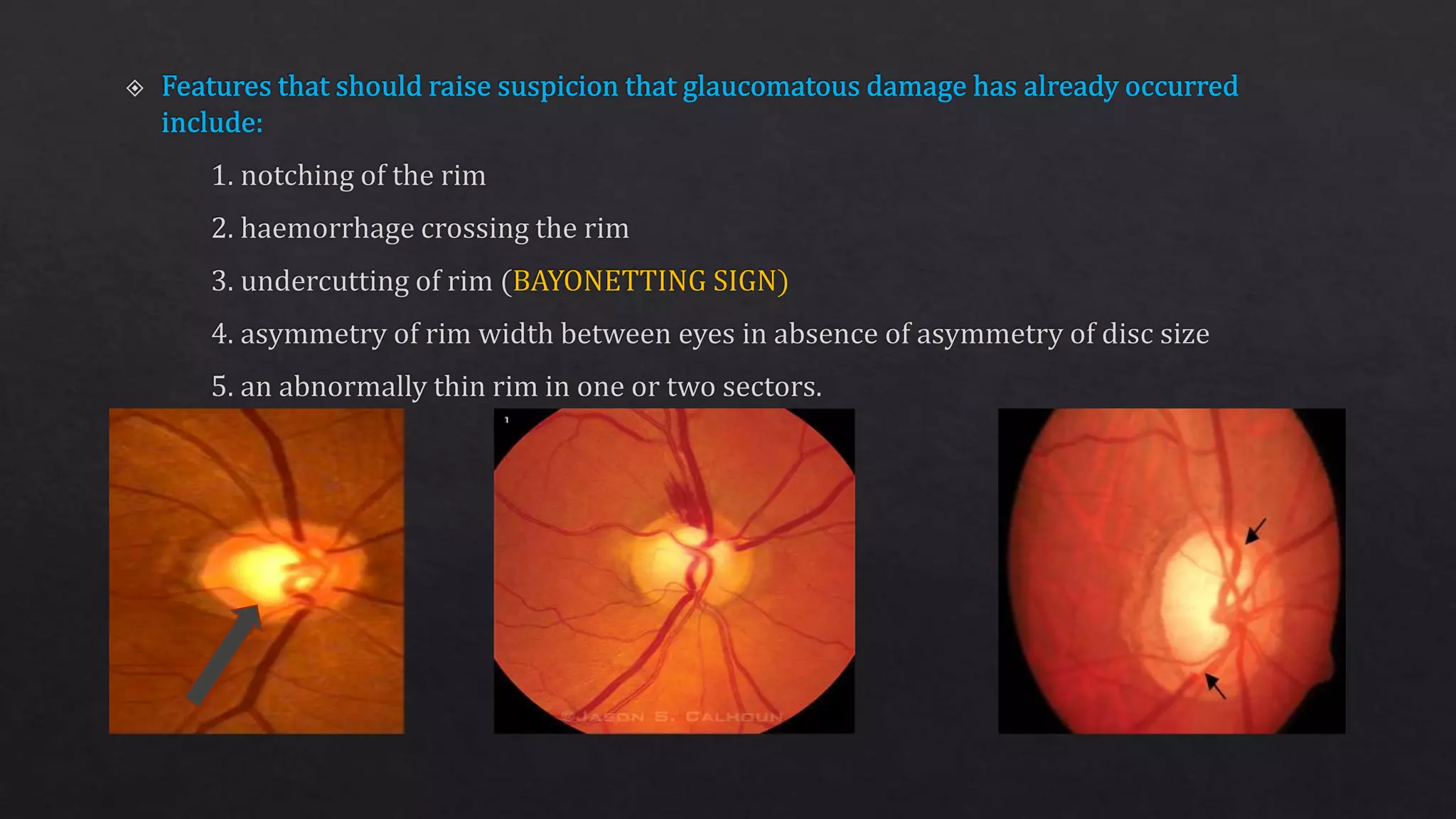 optic disc evaluation in glaucoma.pptx