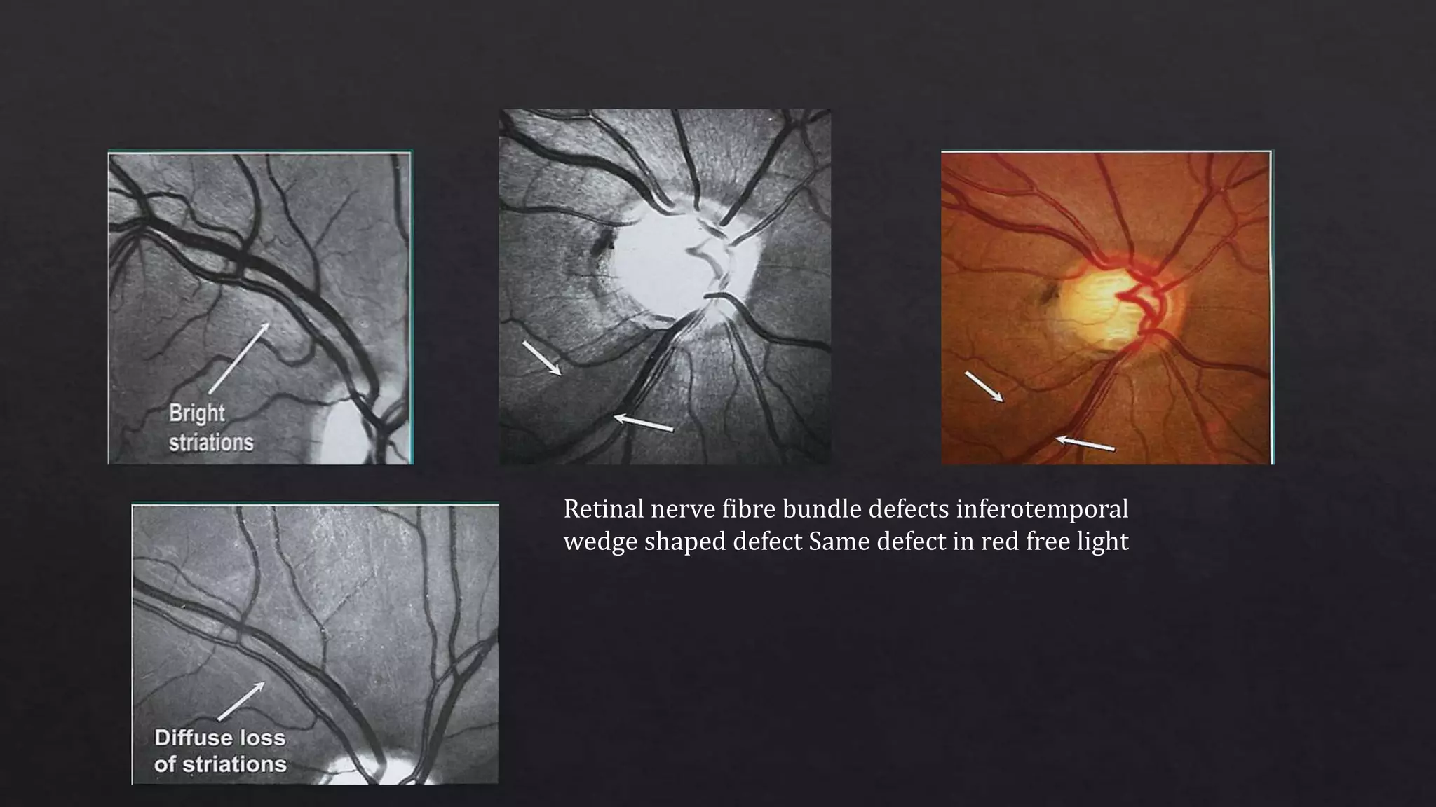 optic disc evaluation in glaucoma.pptx