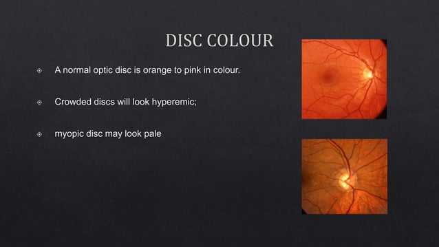 optic disc evaluation in glaucoma.pptx