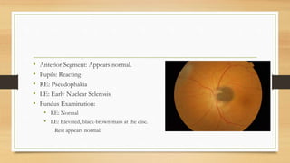 Optic disc melanocytoma | PPTX