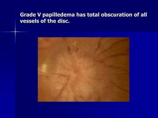Optic disc swelling | PDF