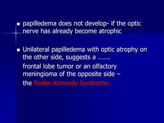 Unilateral Papilledema