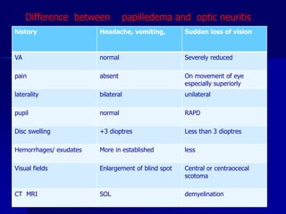 Optic Neuritis Vs Papilledema
