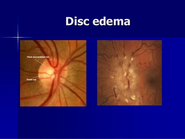 Optic disc swelling
