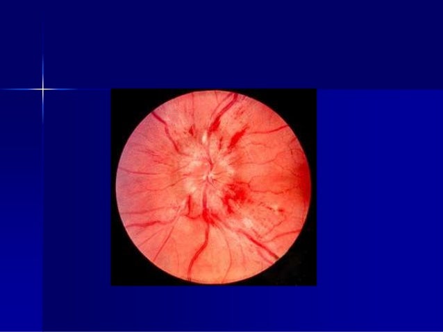 Optic disc swelling