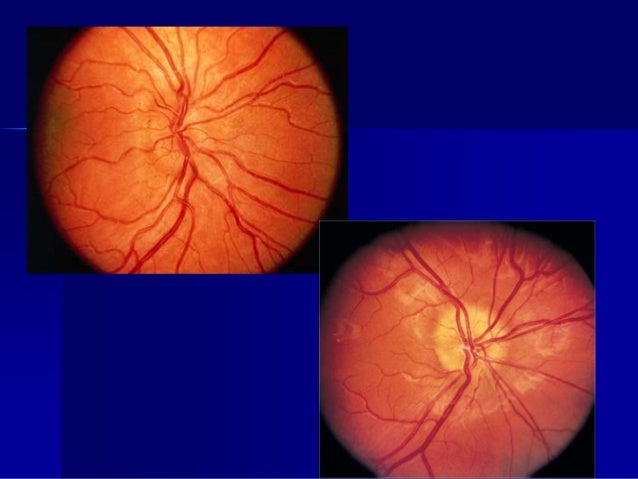 Optic disc swelling