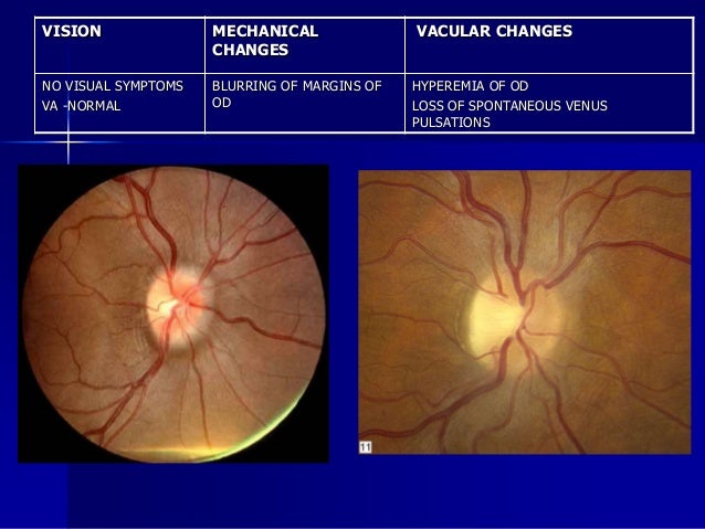 Optic disc swelling