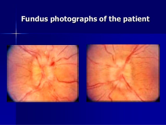 Papilledema Vs Normal Fundoscopy Approach To A Pale Optic Disc