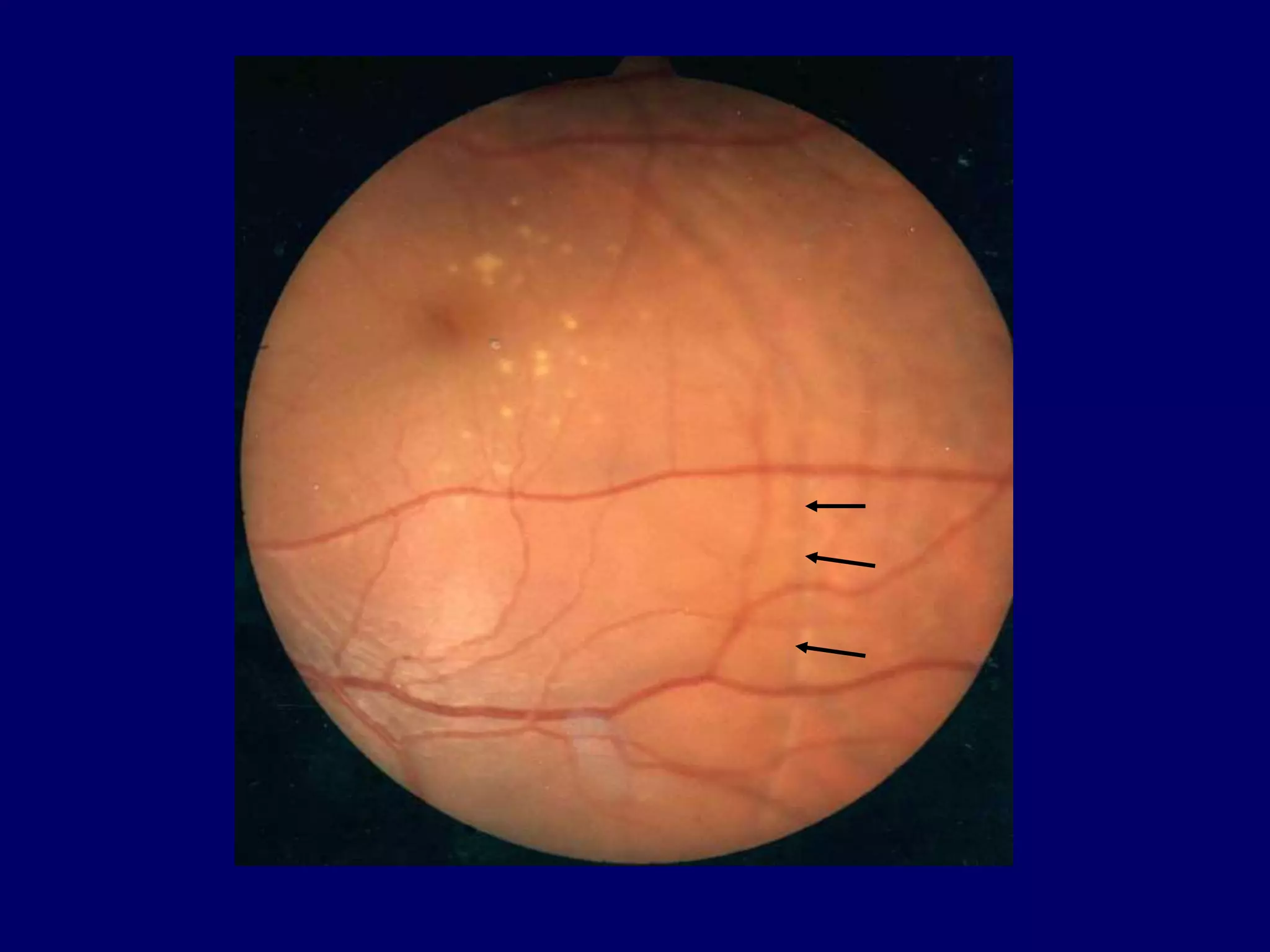 OPTIC DISC PIT Pathogenesis and Management | PPT