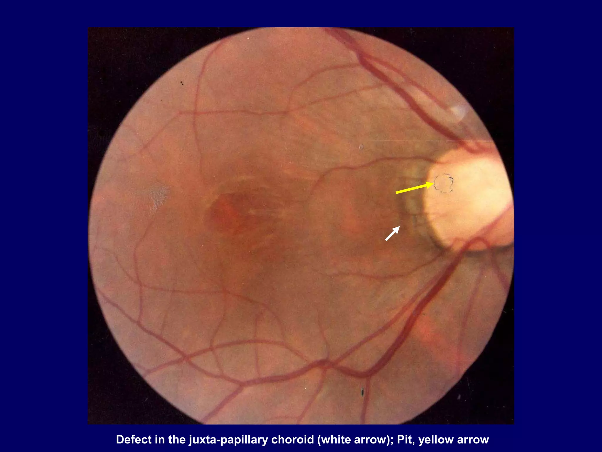 OPTIC DISC PIT Pathogenesis and Management | PPT