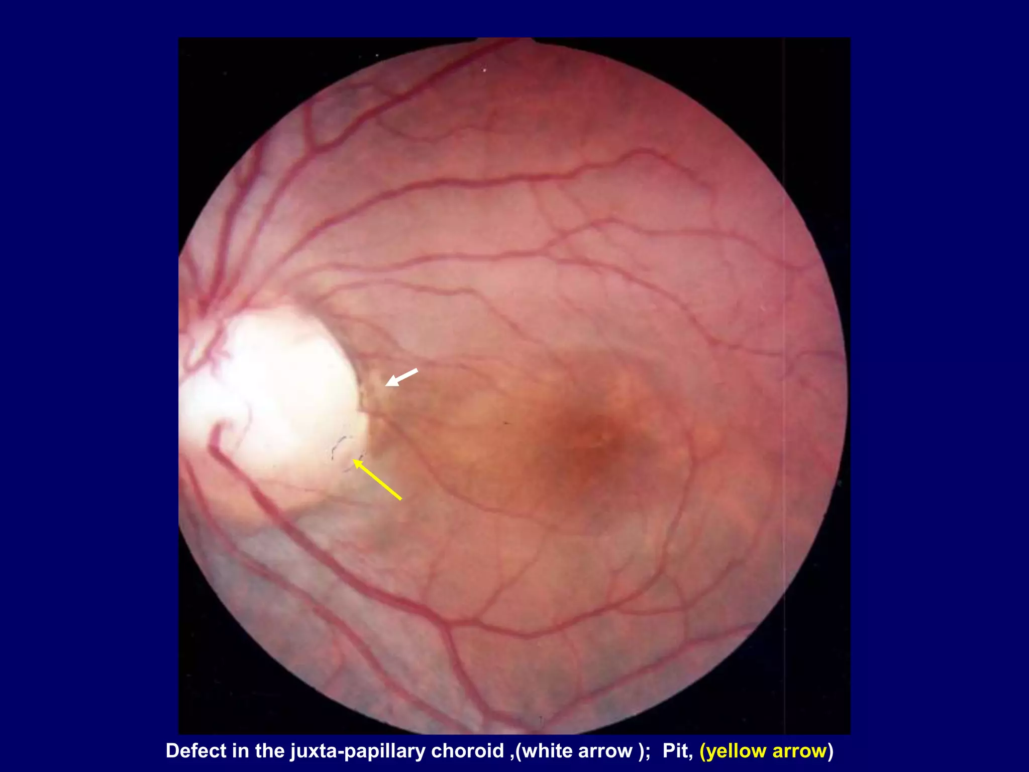 OPTIC DISC PIT Pathogenesis and Management | PPT