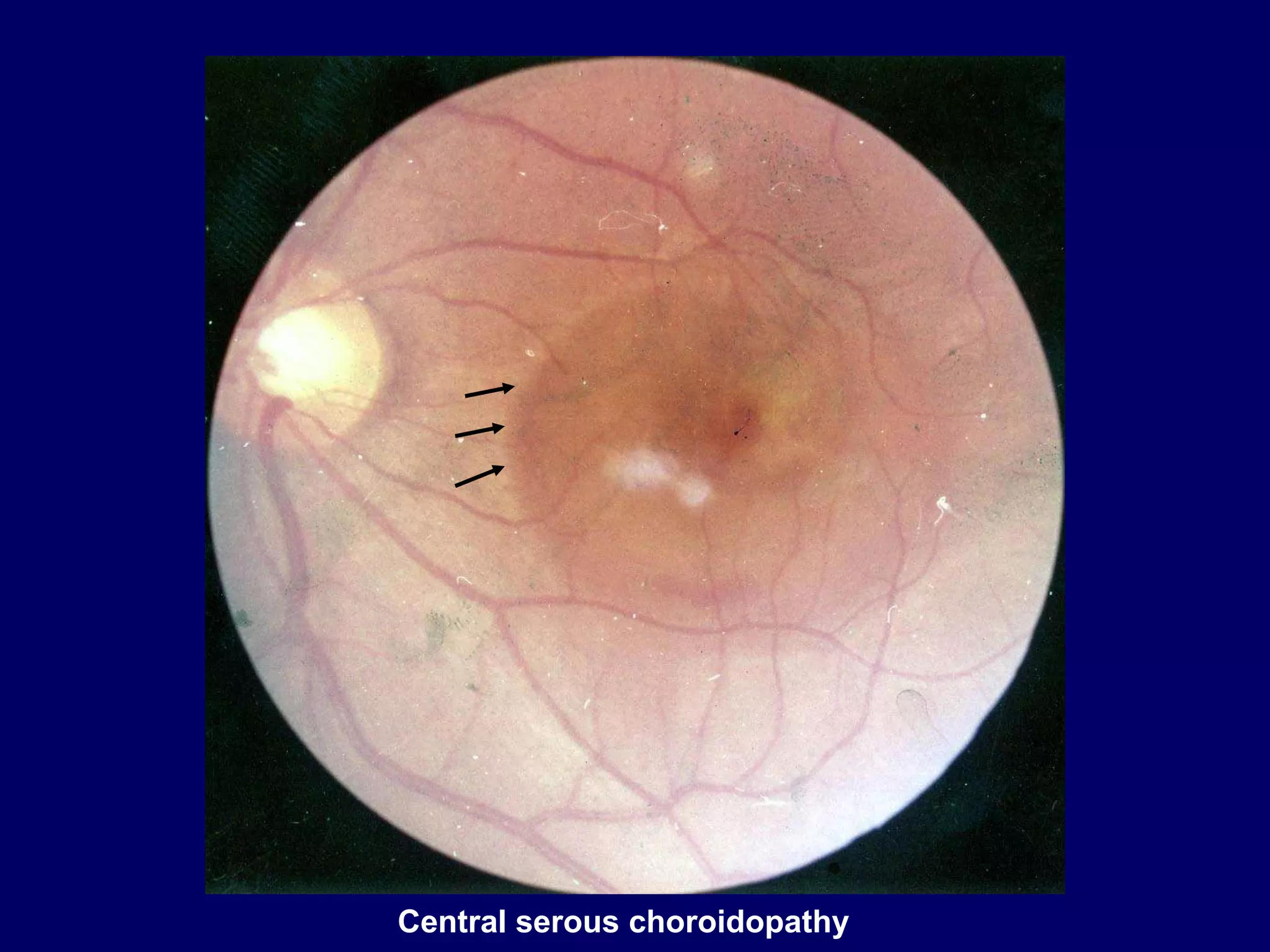 OPTIC DISC PIT Pathogenesis and Management | PPT