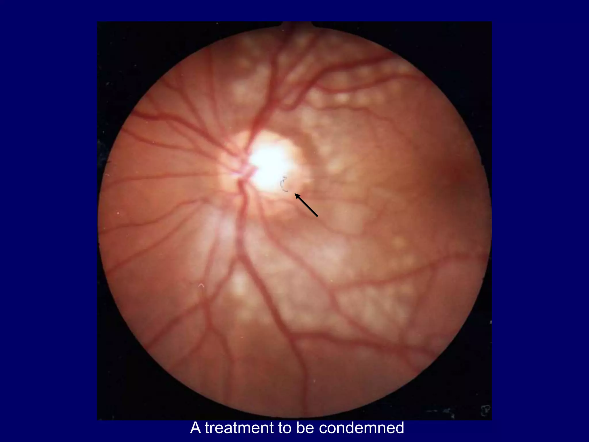 OPTIC DISC PIT Pathogenesis and Management | PPT