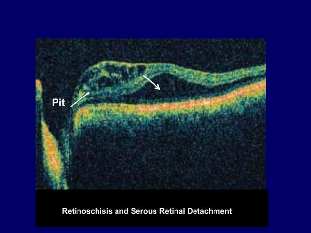 OPTIC DISC PIT Pathogenesis and Management | PPT | Eye and Vision ...