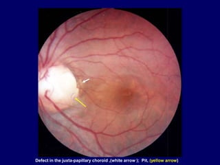 OPTIC DISC PIT Pathogenesis and Management | PPT
