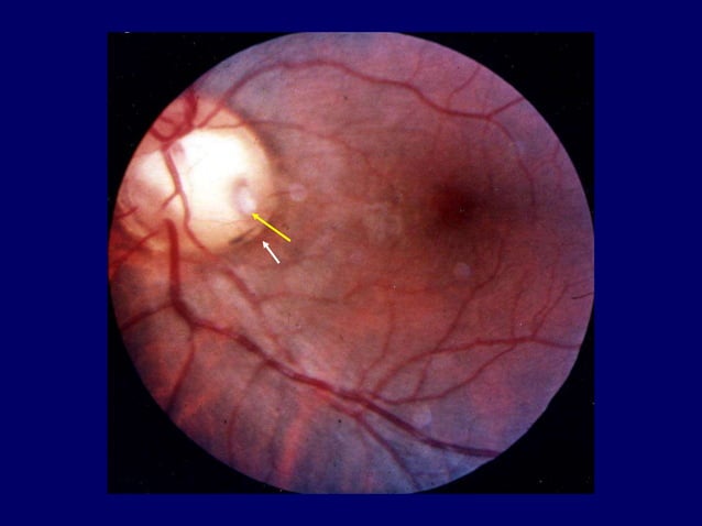 OPTIC DISC PIT Pathogenesis and Management | PPT | Eye and Vision ...