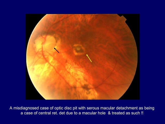 OPTIC DISC PIT Pathogenesis and Management | PPT | Eye and Vision ...