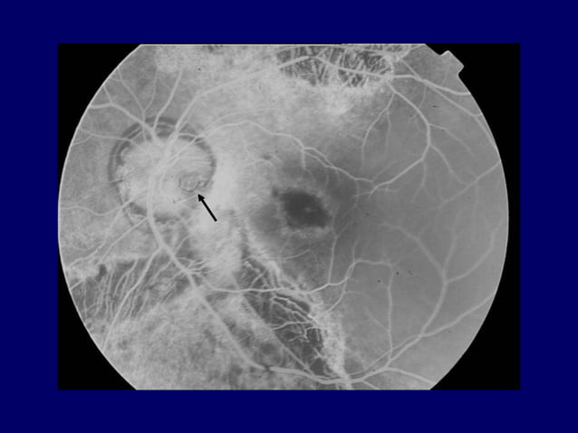 OPTIC DISC PIT Pathogenesis and Management | PPT | Eye and Vision ...
