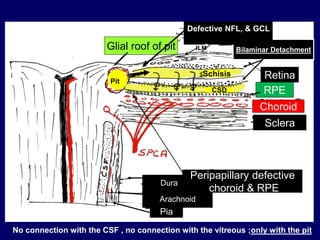 OPTIC DISC PIT Pathogenesis and Management | PPT