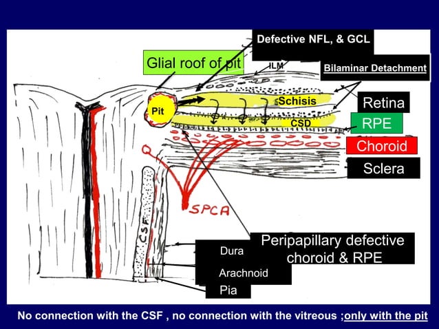 OPTIC DISC PIT Pathogenesis and Management | PPT | Eye and Vision ...