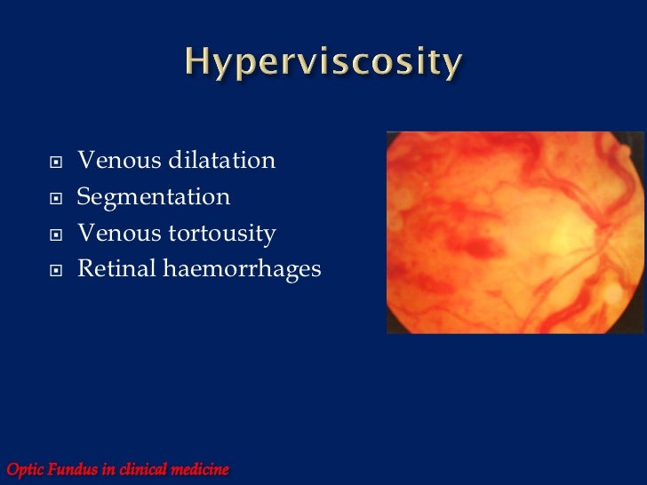 Hyperviscosity Retinopathy