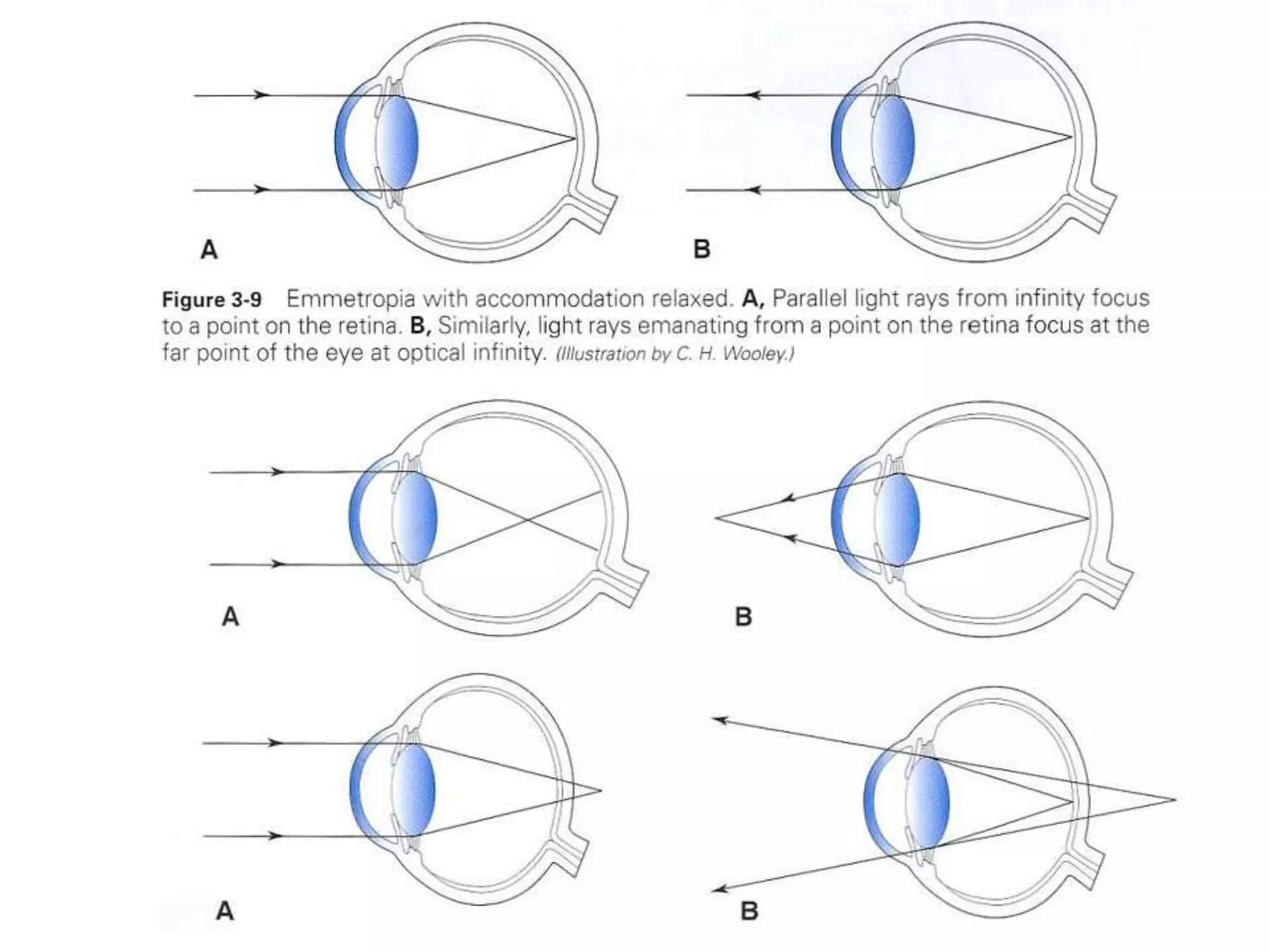 Optic Lens And Iol Ppt