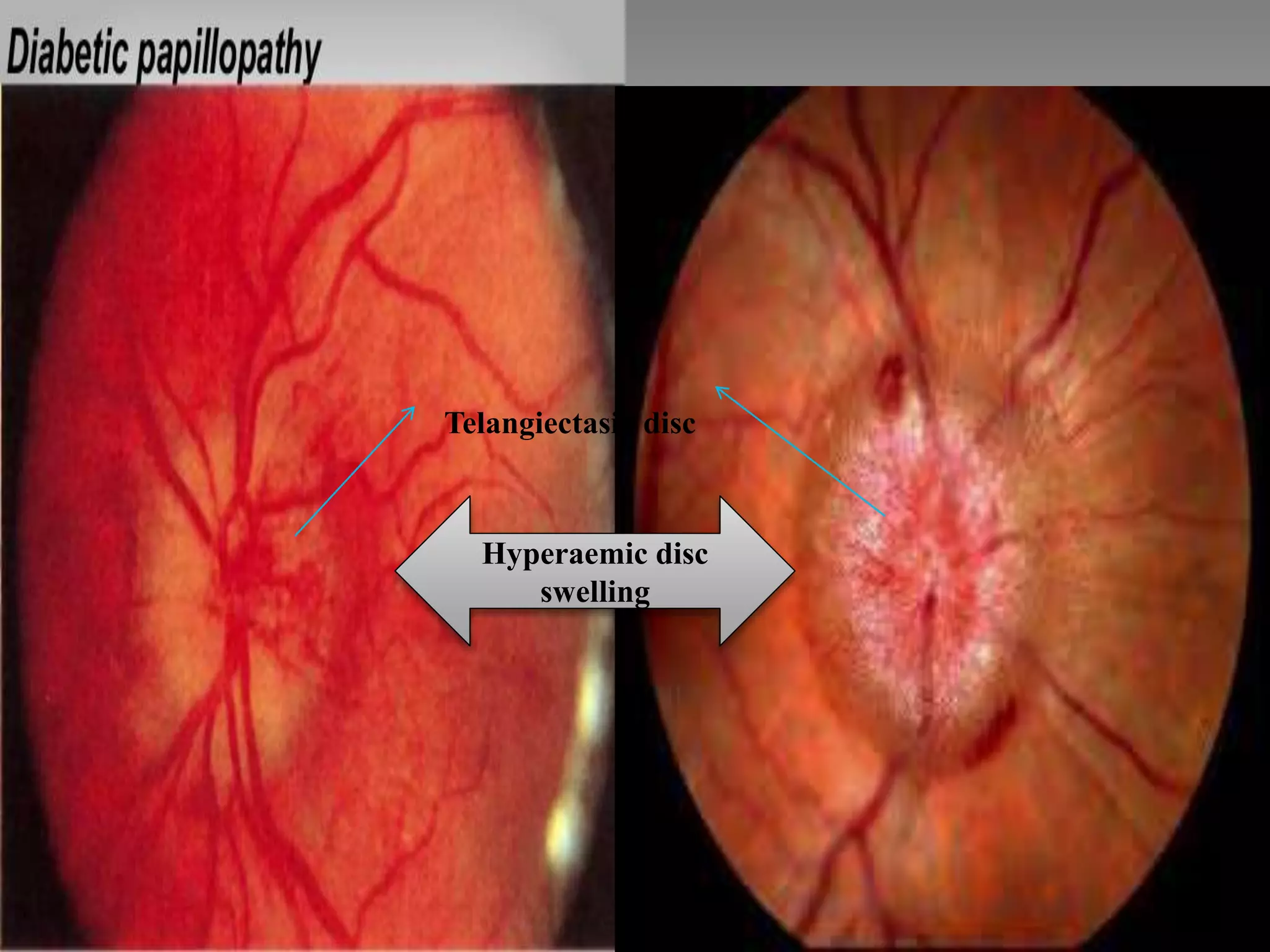Optic nerve and its disorders | PPTX