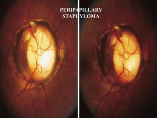 Peripapillary Staphyloma