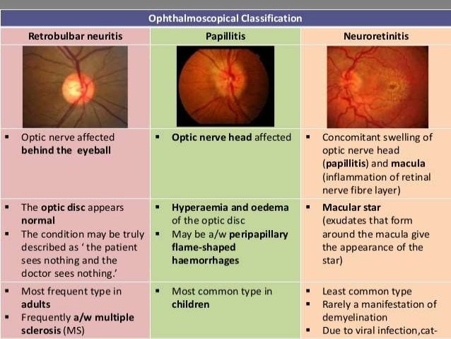 Optic nerve and its disorders