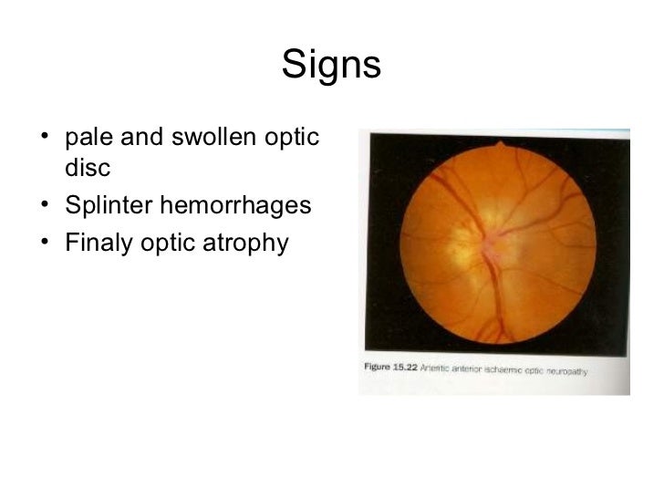 Optic nerve 2
