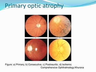Optic Nerve Applied Anatomy, Clinical Evaluation and Approaches.pptx