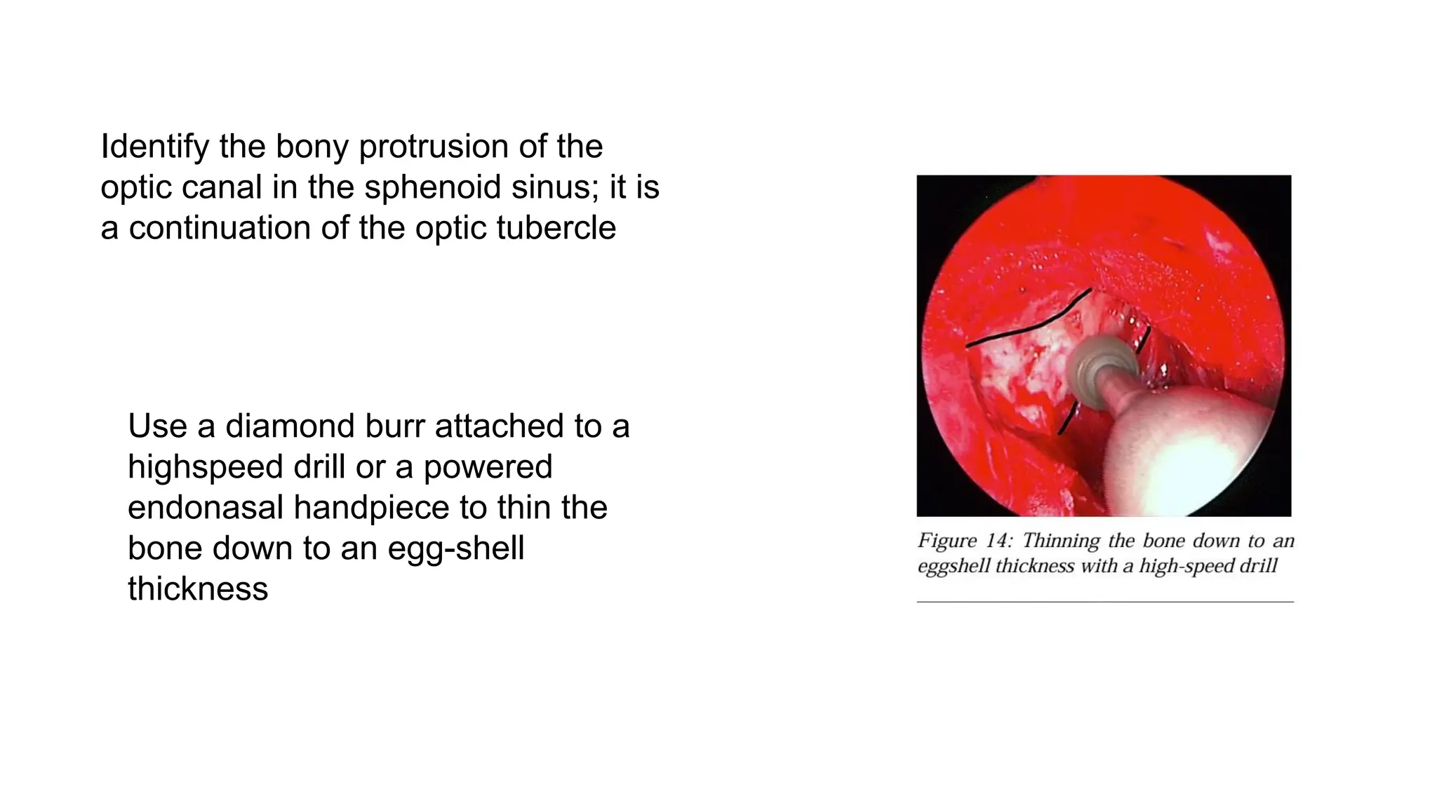 Optic nerve decompression with optic nerve.pdf