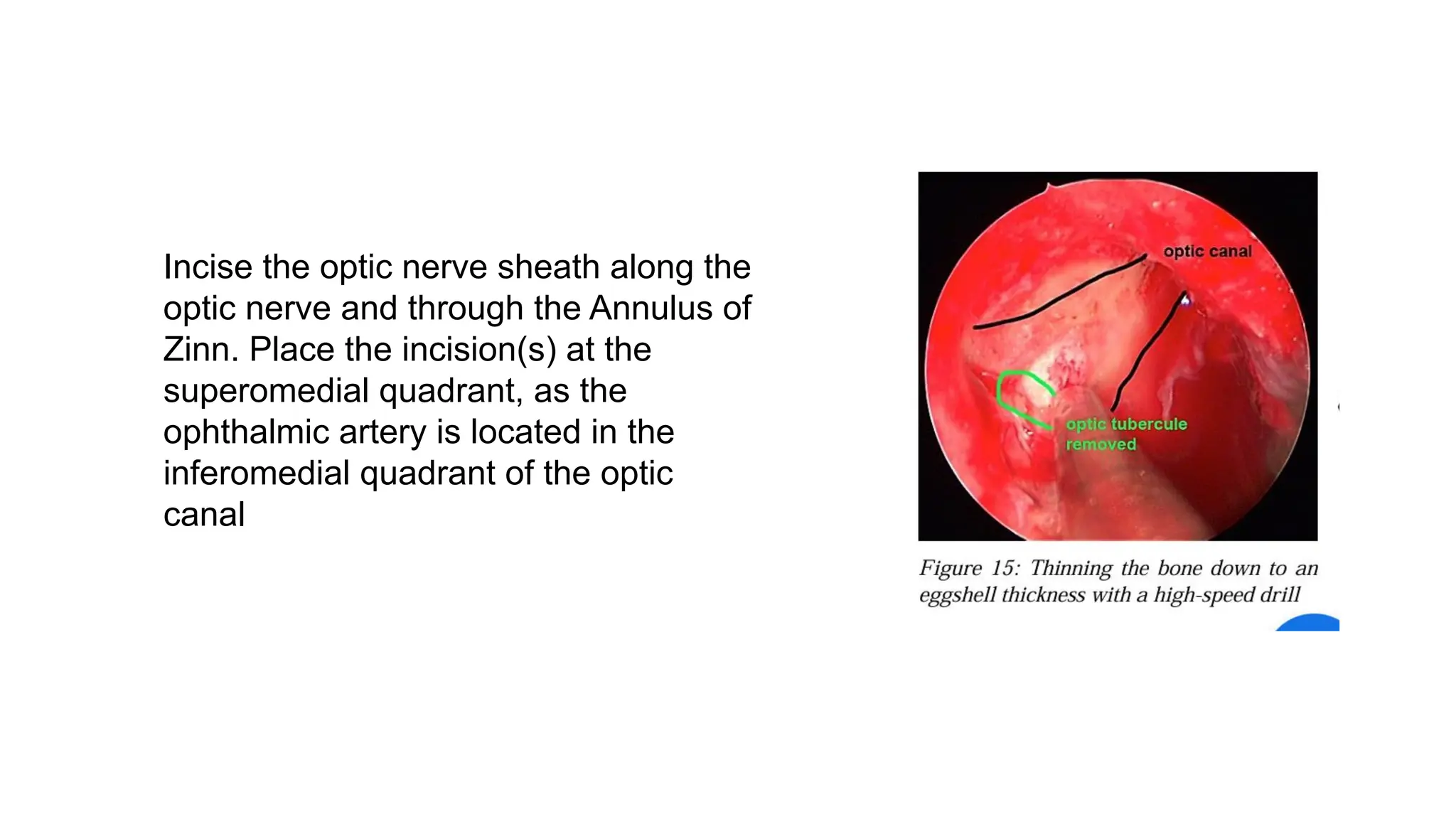Optic nerve decompression with optic nerve.pdf