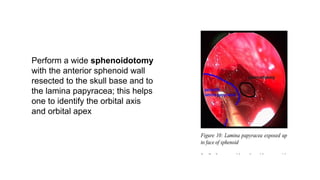 Optic nerve decompression with optic nerve.pdf
