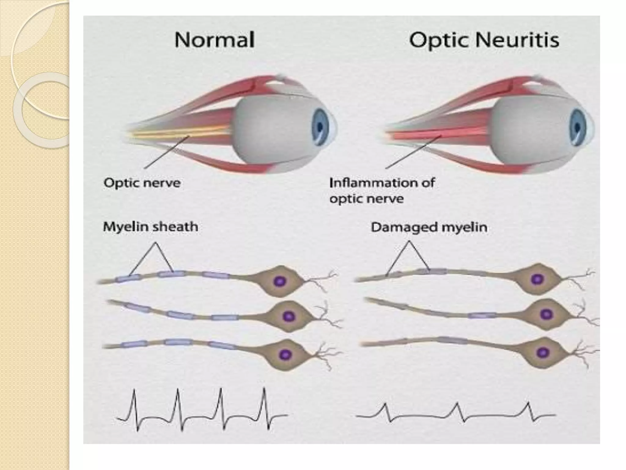 OPTIC NERVE DISEASE | PPTX