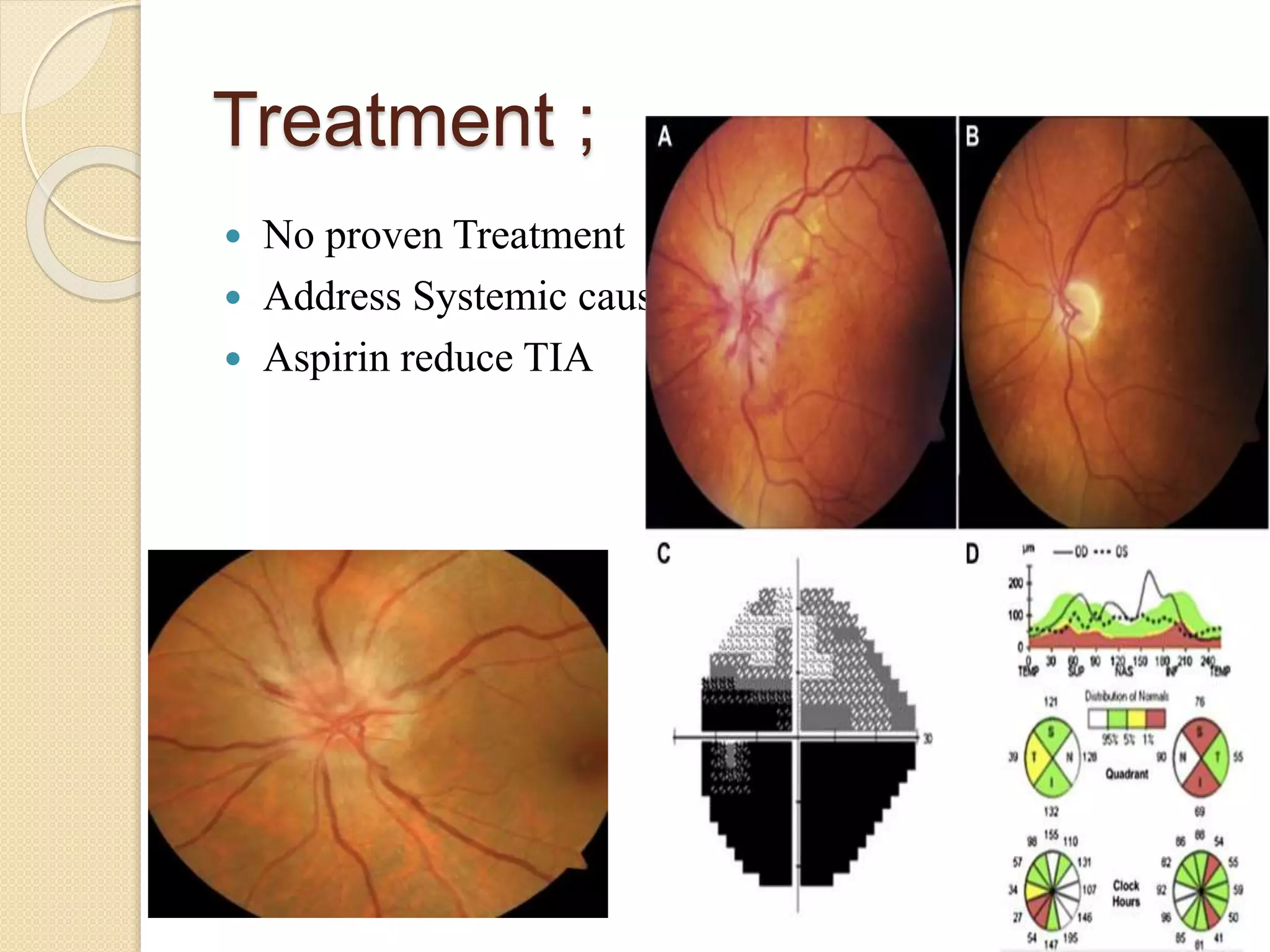 OPTIC NERVE DISEASE | PPTX