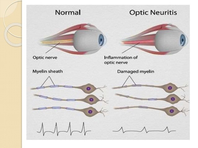 OPTIC NERVE DISEASE | PPTX
