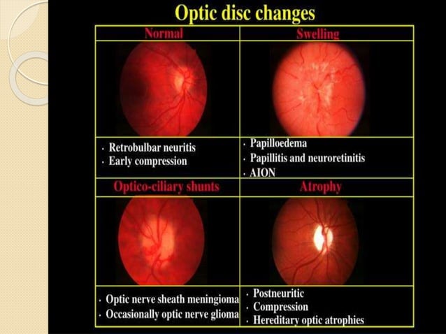 OPTIC NERVE DISEASE | PPTX