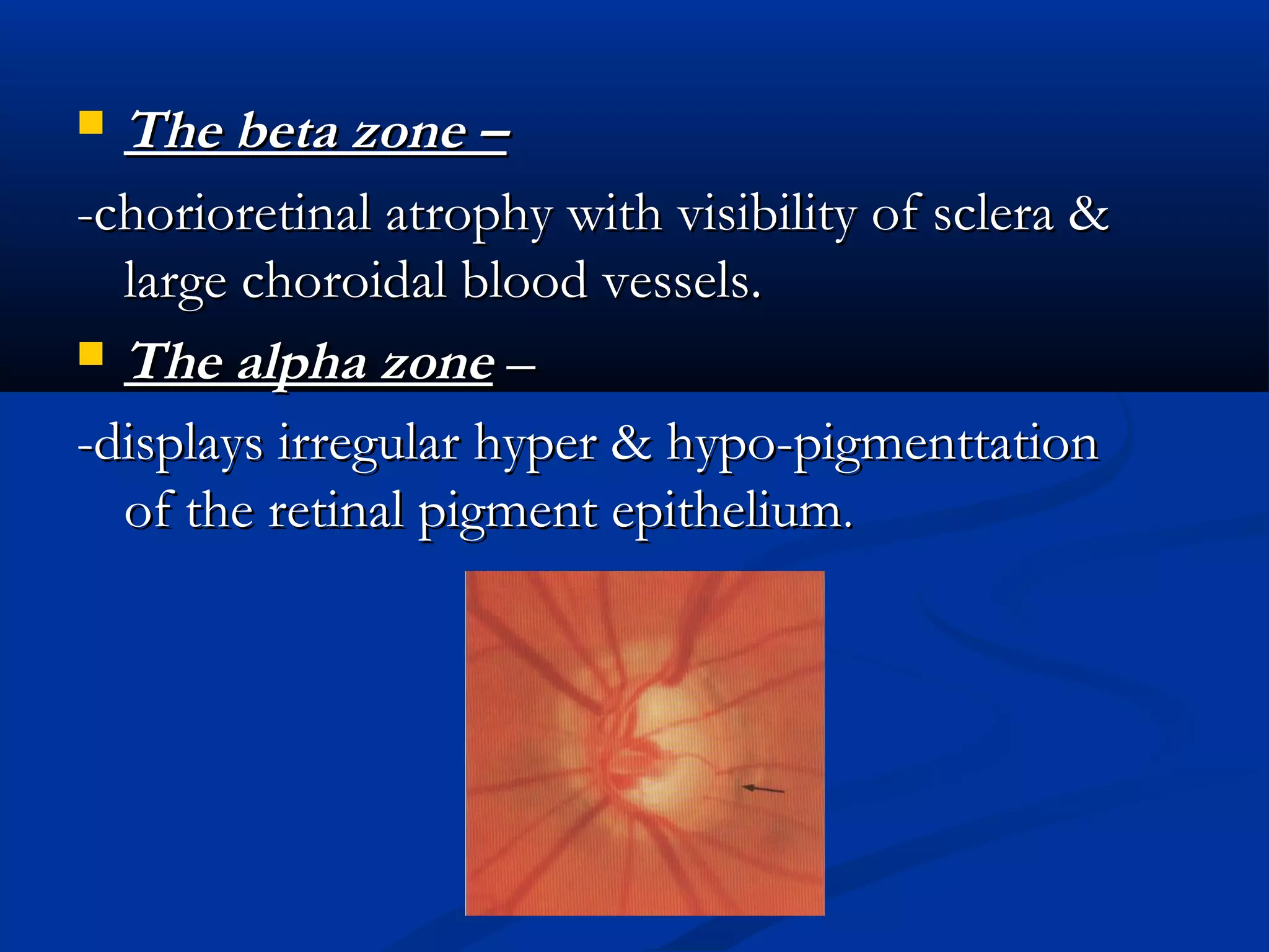 Optic nerve head evaluation | PPT