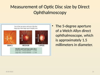 Optic Nerve Head Evaluation for glaucoma | PPTX