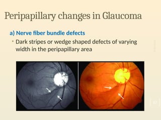 Optic Nerve Head Evaluation for glaucoma | PPTX